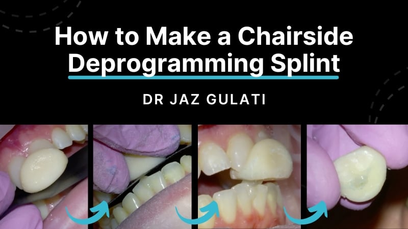 How to Make a Chairside Deprogramming Splint
